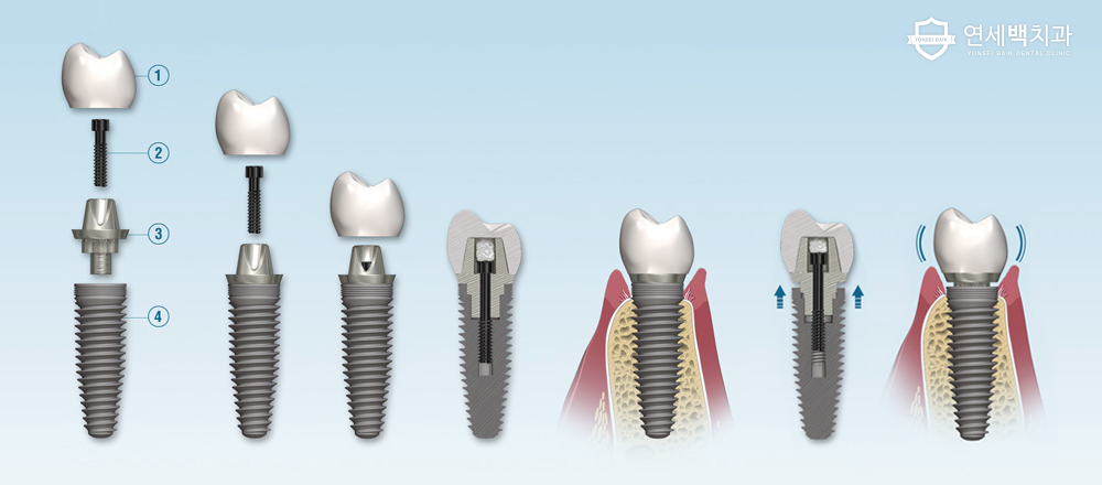 연세백치과 칼럼 임플란트가 빠졌어요 임플란트의 구조